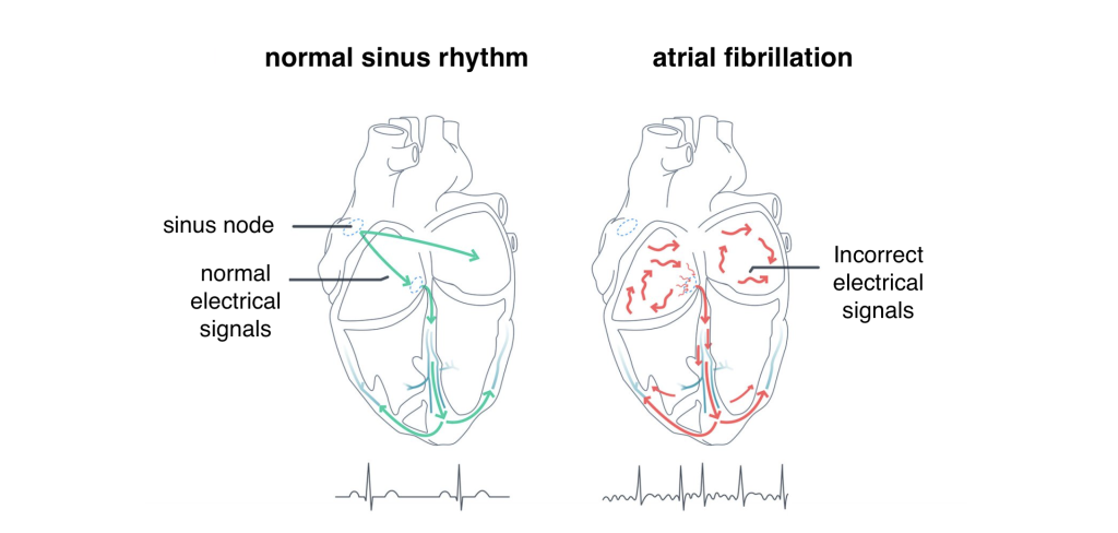 APP - Atrial fibrillation - Preventicus Heartbeats ...